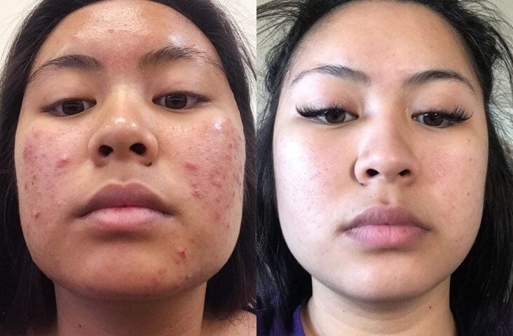 Curology Reviews | Skincare Treatments & Results | Curology