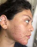 Treat Acne, Fine Lines and More | Curology Custom Skincare