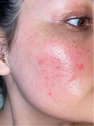 Tretinoin Prescription - Curology Custom Formula