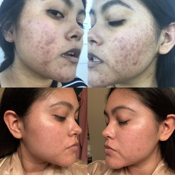 Curology Reviews | Skincare Treatments & Results | Curology